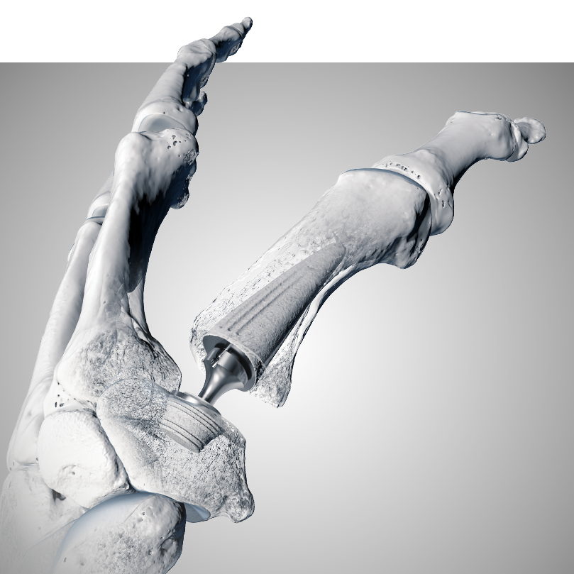 KeriMedical | Hand & Wrist Implants, CMC & Wrist Prostheses